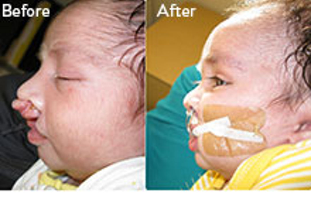 Nasoalveolar Molding (NAM) - Stanford Medicine Children's Health