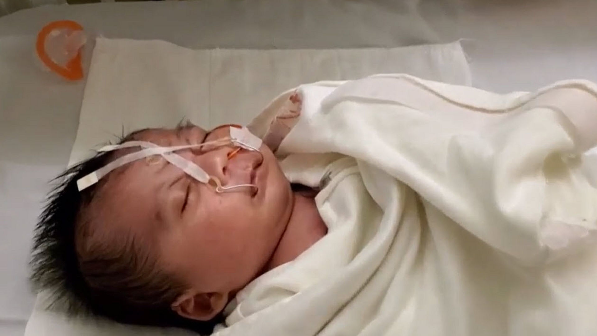 Stanford Orthodontic Airway Plate Treatment Program (SOAP) Photo ...