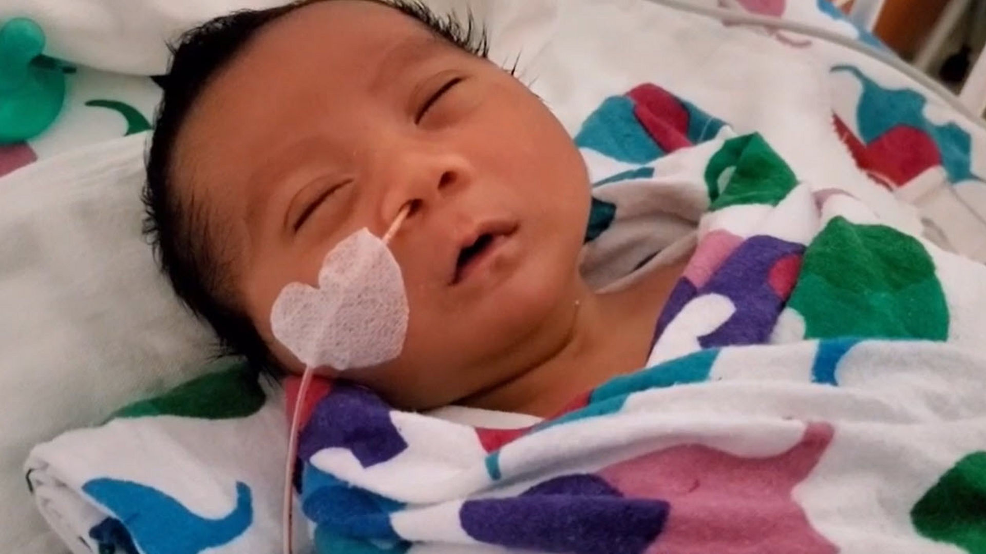 Stanford Orthodontic Airway Plate Treatment Program (SOAP) Photo Gallery - Stanford Medicine ...