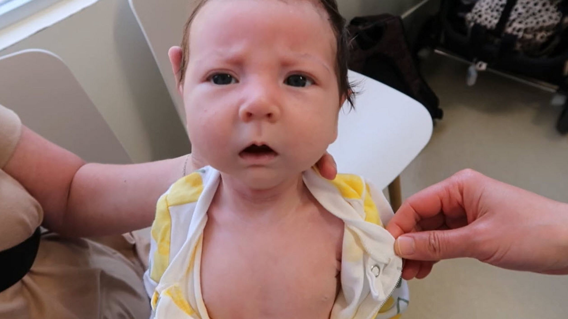 Stanford Orthodontic Airway Plate Treatment Program (SOAP) Photo ...