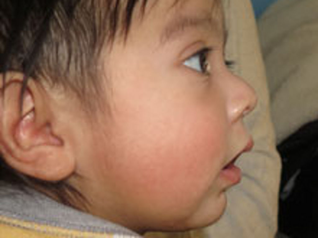 What is an Orthodontic Airway Plate (OAP) - Stanford Orthodontic Airway ...