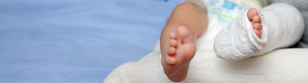 Clubfoot Program - Stanford Medicine Children's Health